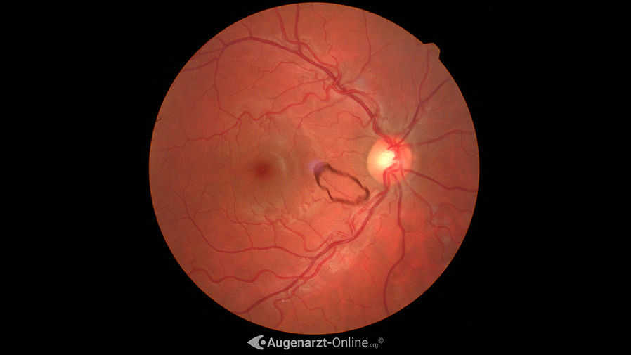 Weiss Ring | Lexikon der Augenheilkunde